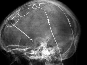 Open Source Brain Computer Interface for Arduino | Elektor Magazine